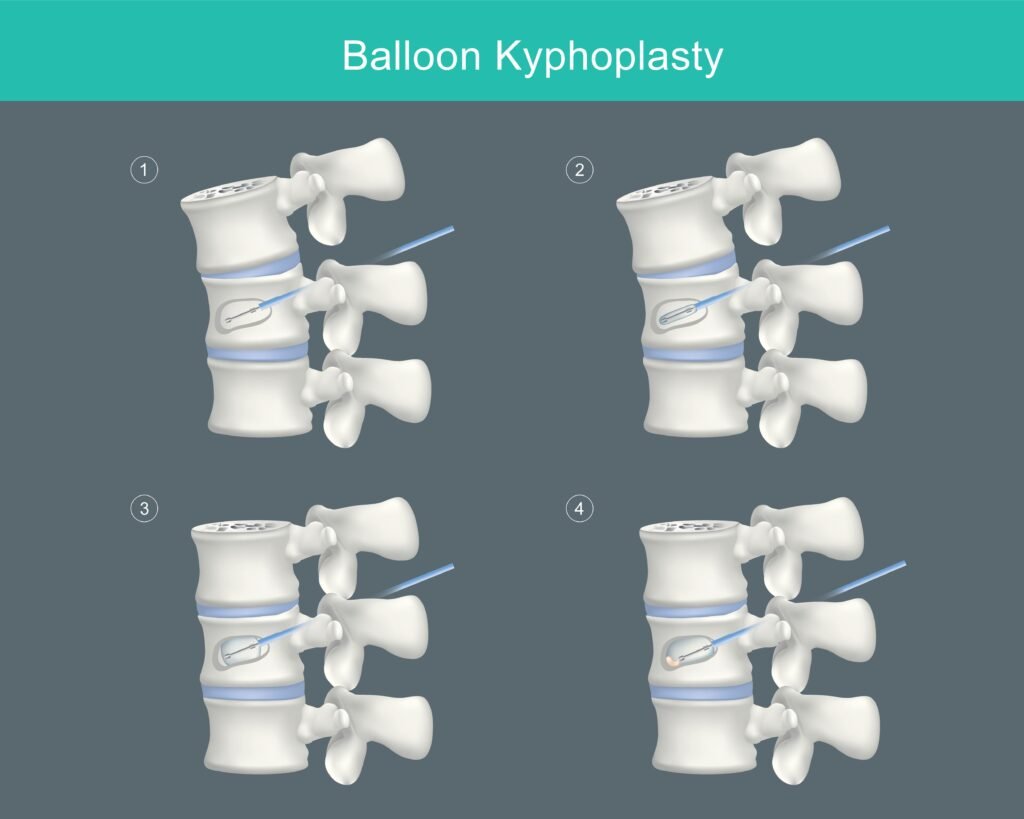 Kyphoplasty Surgery: Restoring Spinal Stability and Relieving Pain